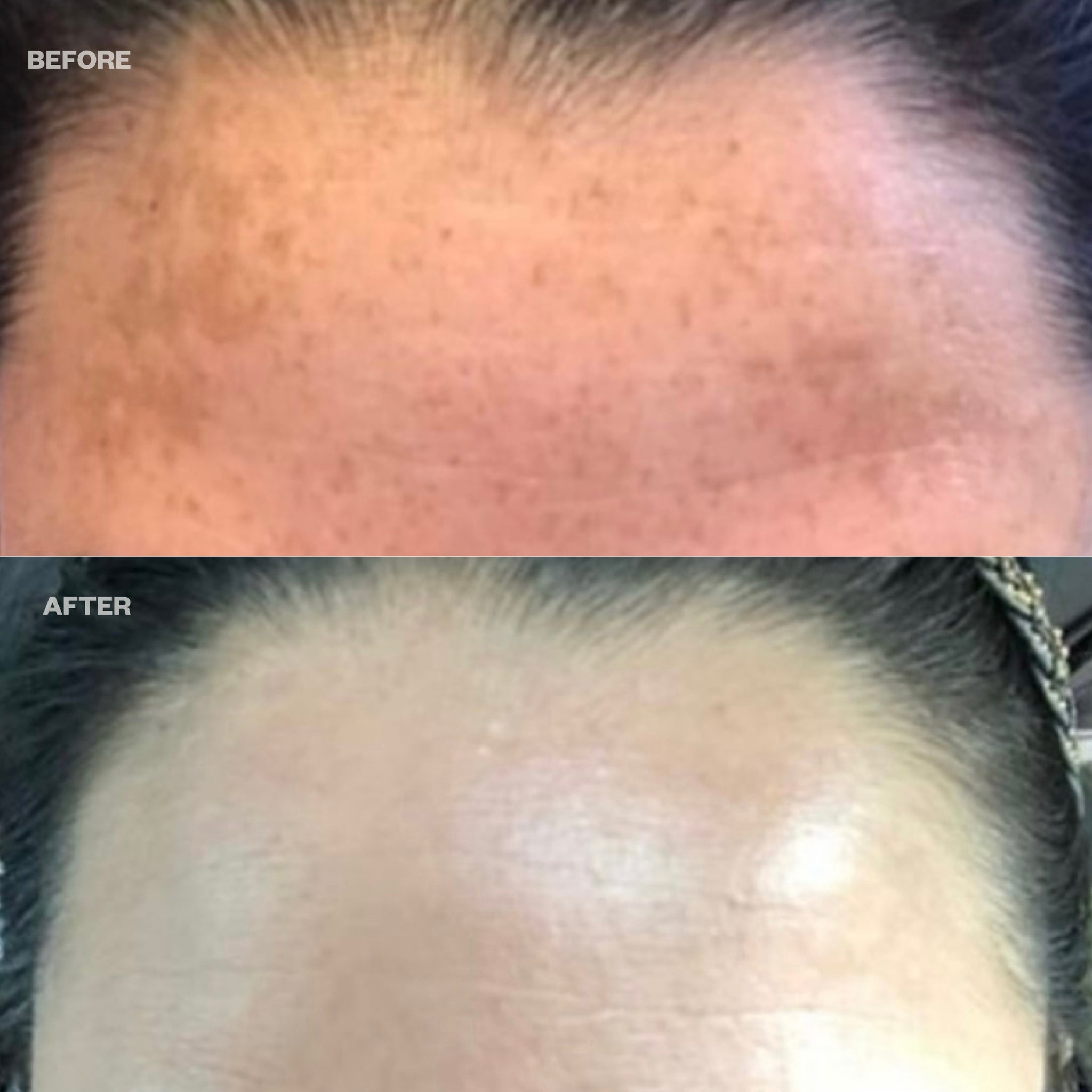 Dermabright Pads | Hyperpigmentation, Discoloration - AziMD Skincare
