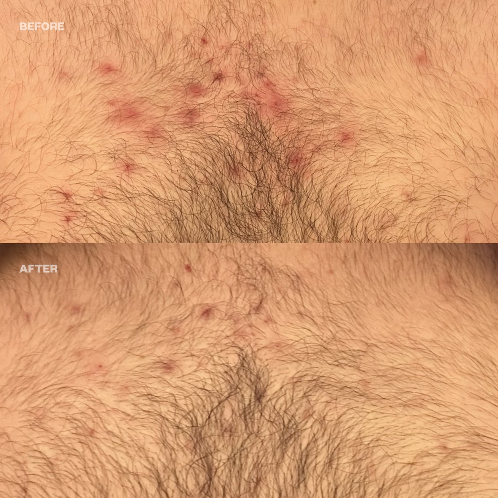 The One | Ultimate Acne Treatment Body Spray - AziMD Skincare