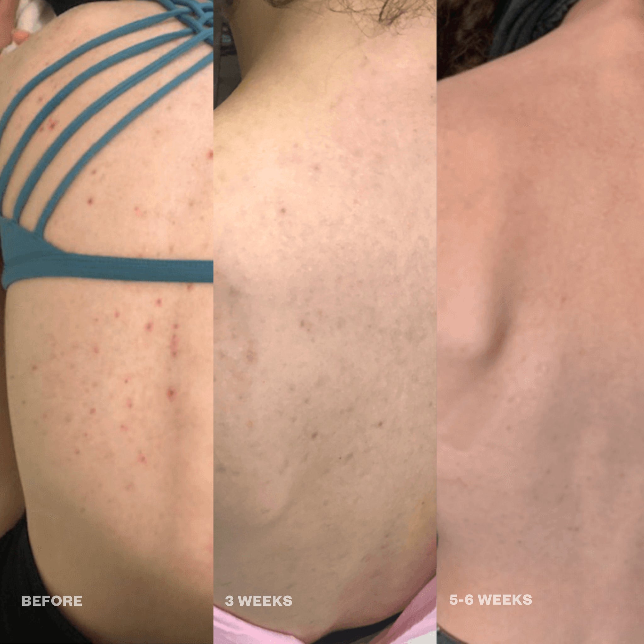 The One | Ultimate Acne Treatment Body Spray - AziMD Skincare