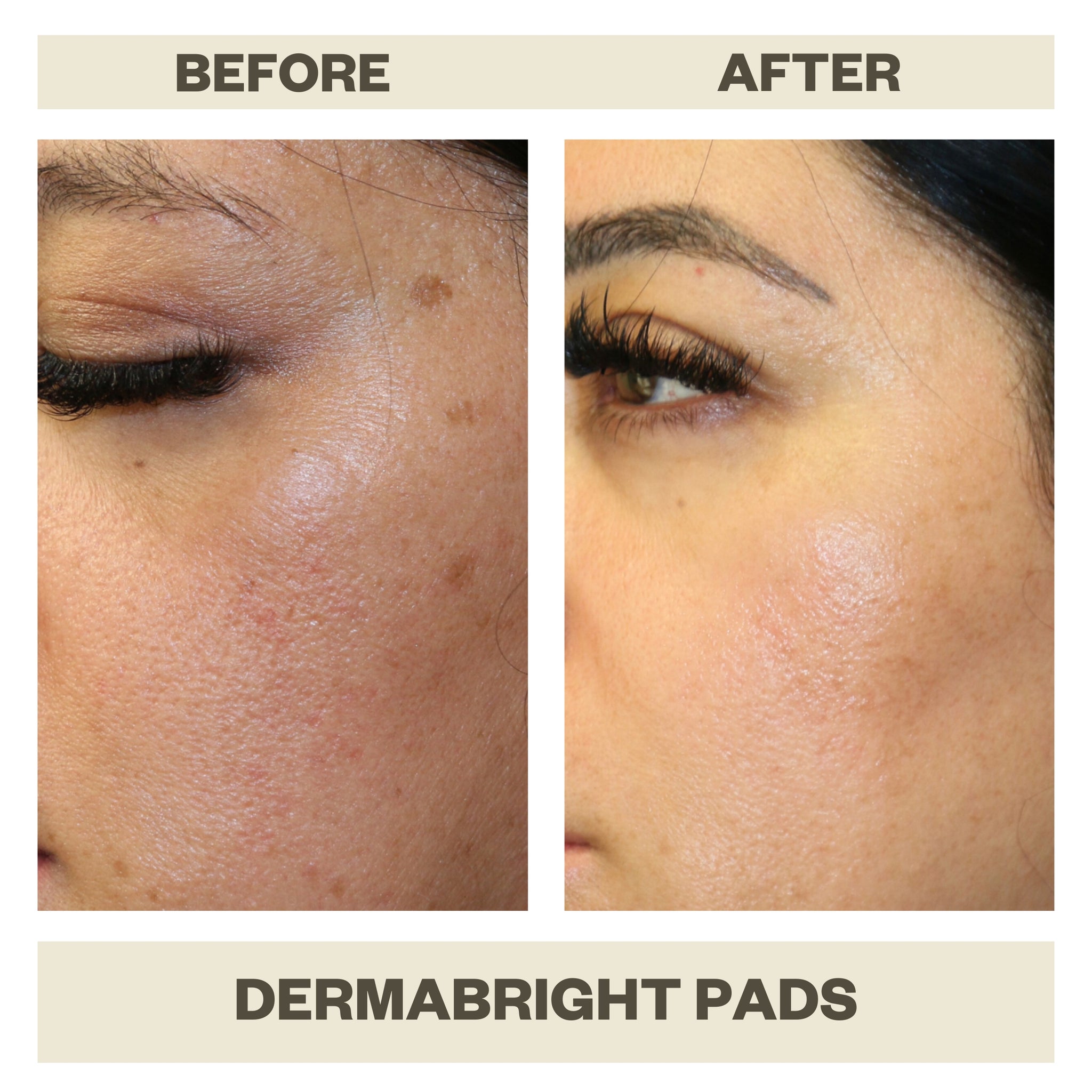 DermaBright Pads | Hyperpigmentation, Melasma, Discoloration | AziMD ...